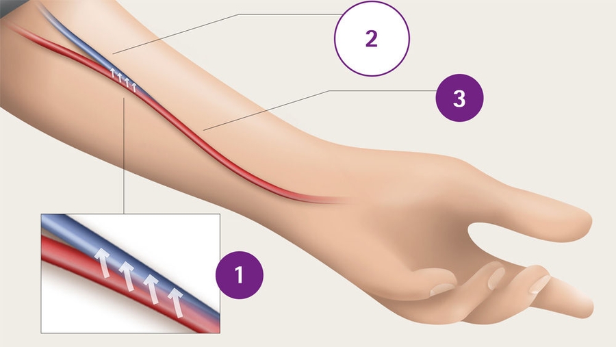 Hemodialysis: Understanding its process